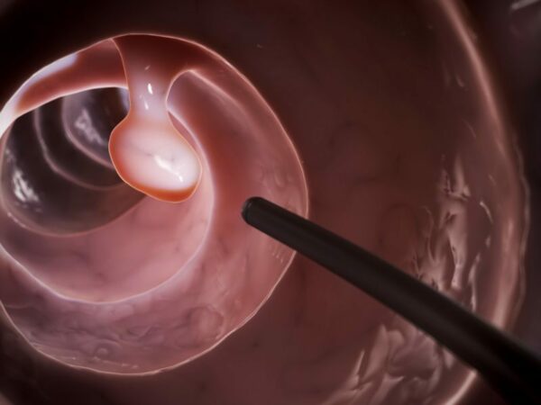 Polyp là gì? Phân biệt 3 loại Polyp phổ biến và cách điều trị