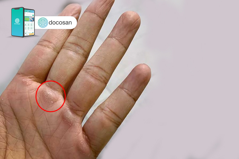 Chai tay: Nguyên nhân, cách xử lý hiệu quả