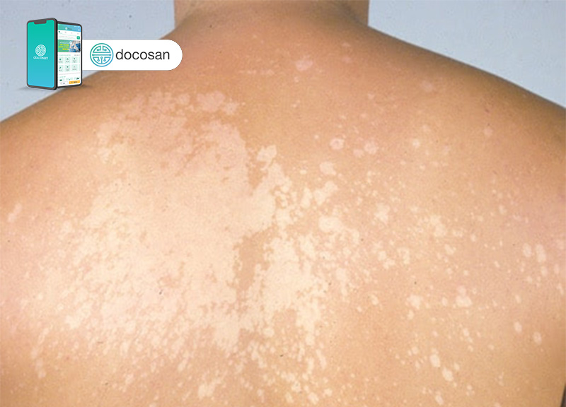 Lang ben: Triệu chứng, nguyên nhân và cách điều trị | Doctor có sẵn