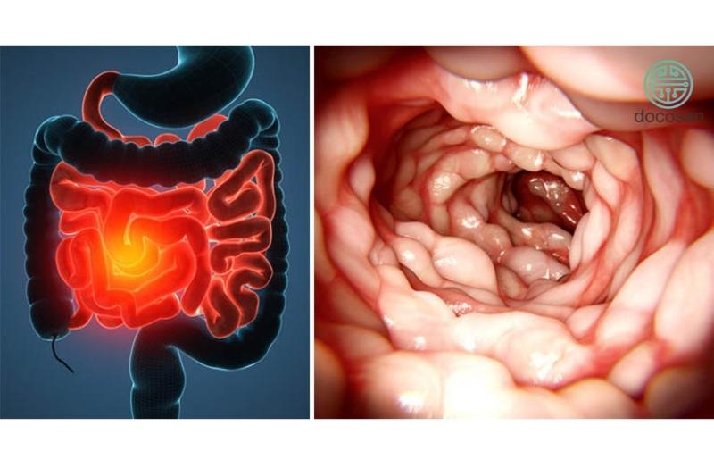 Bệnh Crohn: 1 số nguyên nhân, triệu chứng và cách điều trị | Doctor có sẵn
