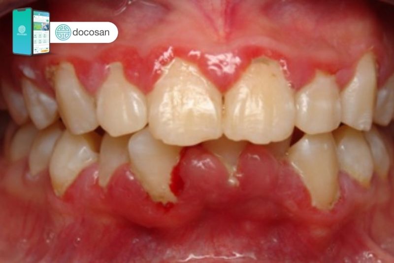 5 cách trị sưng nướu răng có mủ tại nhà cực kì hiệu quả | Doctor có sẵn