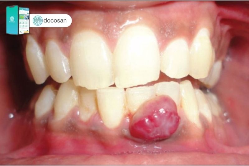 Viêm sưng chân răng có mủ: Nguyên nhân và cách điều trị | Doctor có sẵn