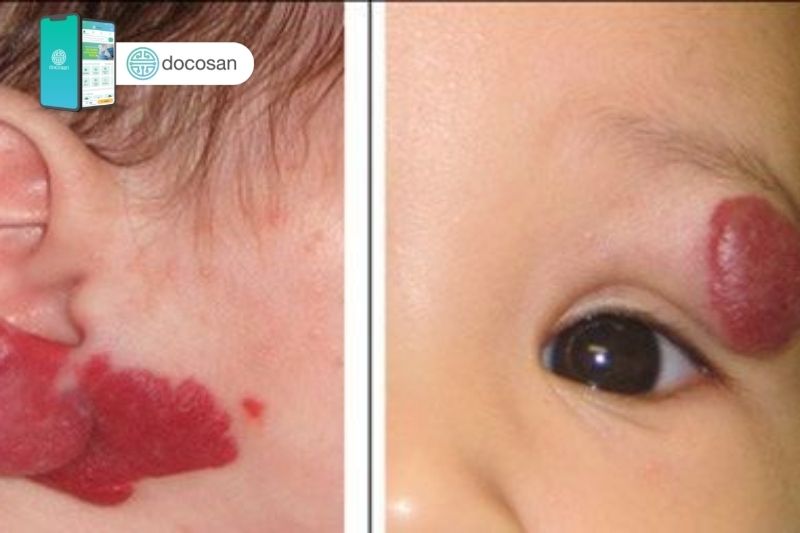 BST 300+ hình ảnh u máu trong miệng chất lượng full HD - Wikipedia