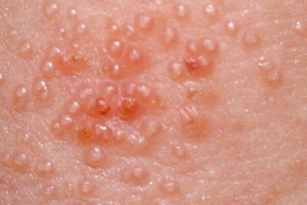 U mềm lây là gì? Nguyên nhân, dấu hiệu, cách điều trị