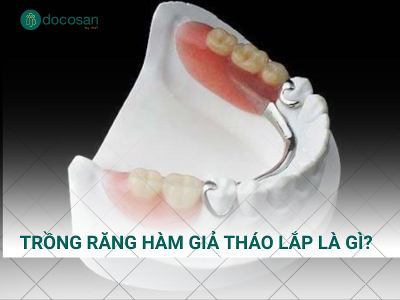 Trồng răng hàm giả tháo lắp là gì? Nơi trồng răng tháo lắp